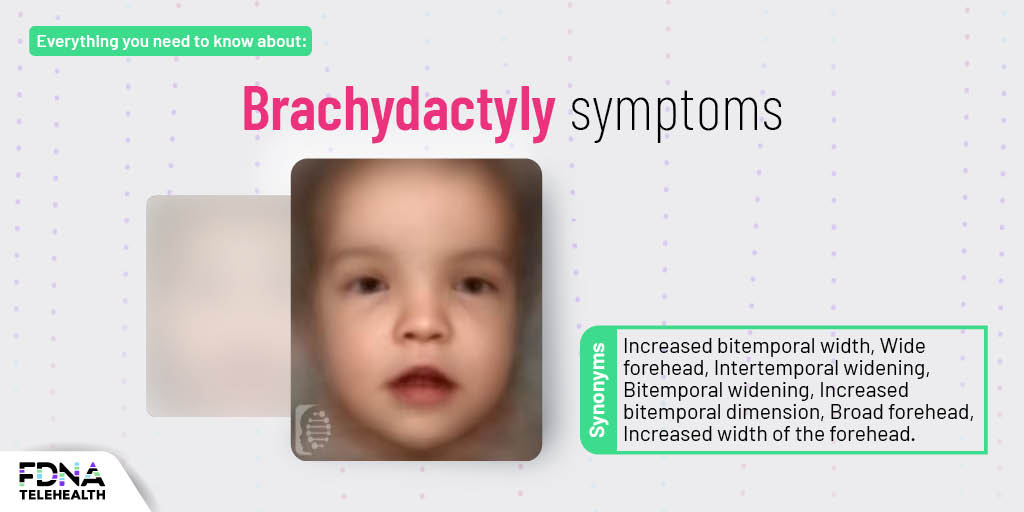 Dedos cortos (braquidactilia), definición y causas