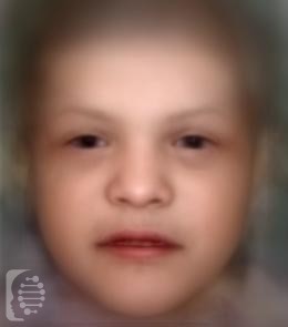 Brauer syndrome/Focal Facial Dermal Dysplasia: causes and symptoms